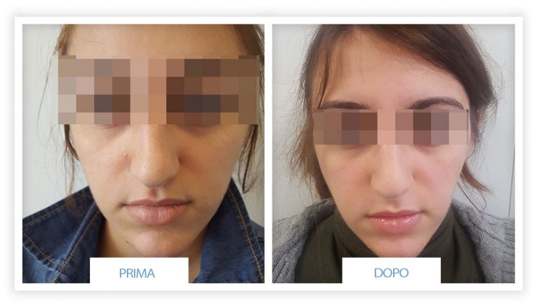 Rinoplastica Prima & Dopo 1 - Centro Italiano Chirurgia Estetica